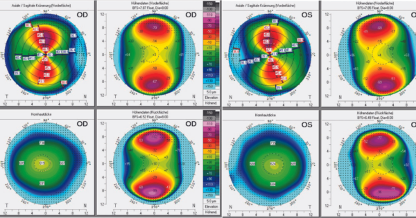 CRST Global | Extreme Astigmatism in a Pre-Presbyopic Patient
