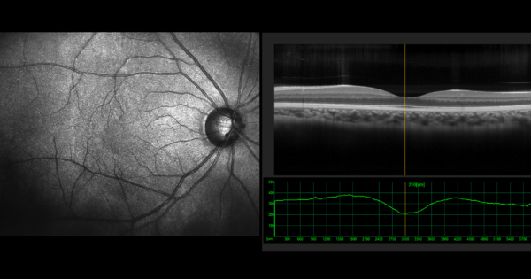 CRST Global | Macular OCT Imaging Before Cataract Surgery