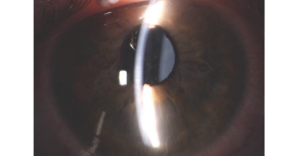 CRST Global | Excessive Vaulting of a Phakic IOL